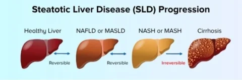 Diabetes Described: What is Liver Disease? – Revive Wellness